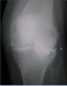 Impaired Physical Immobility Nursing Diagnosis And Nursing Care Plan ...